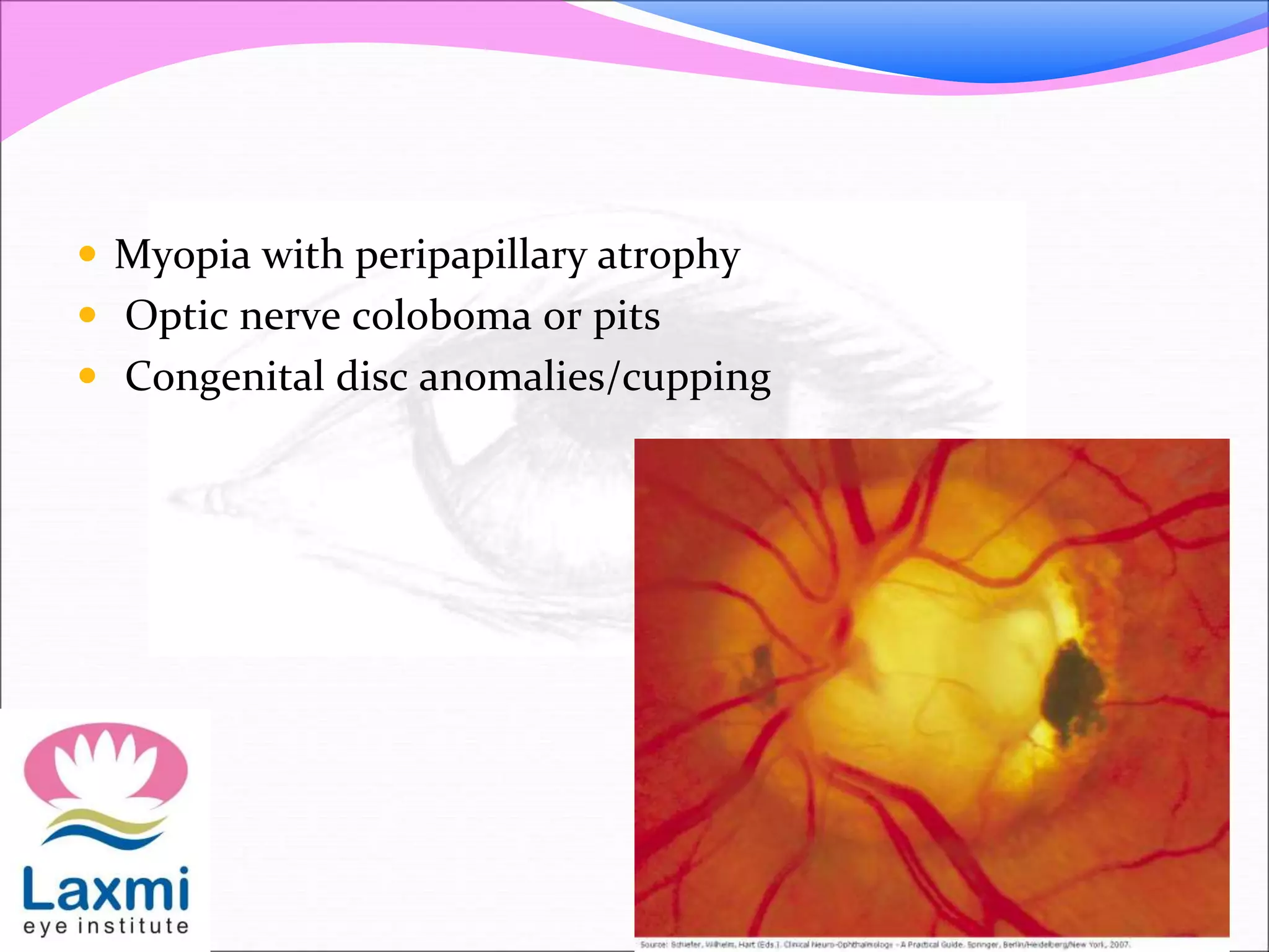 Normal tension glaucoma | PPTX