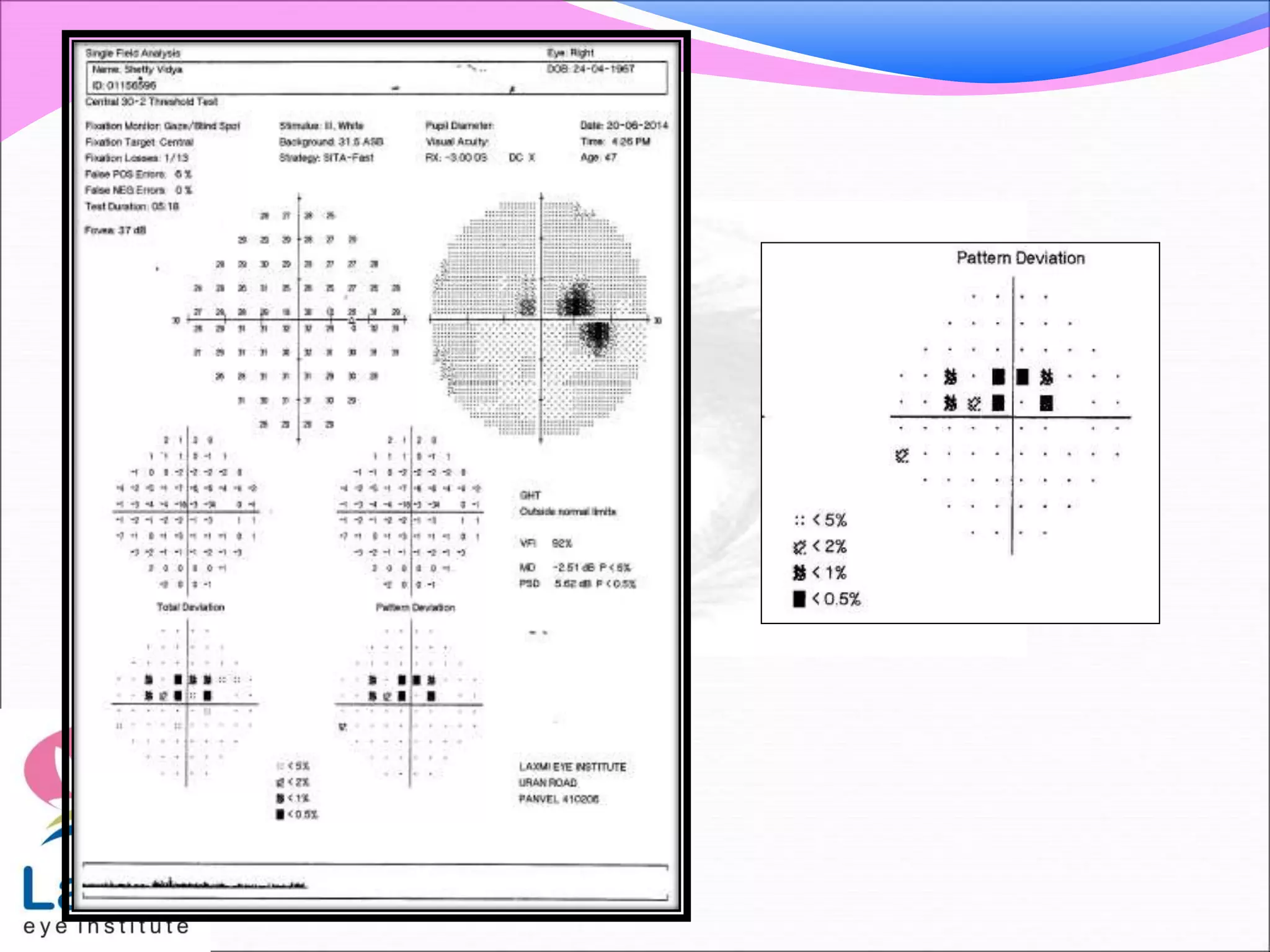 Normal tension glaucoma | PPTX