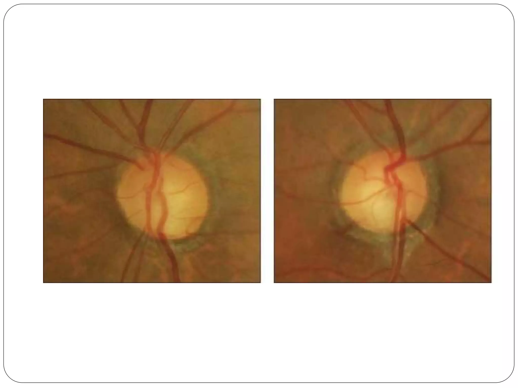 Normal tension glaucoma | PPTX