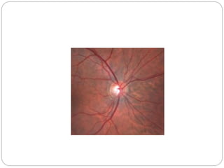 Normal tension glaucoma | PPTX