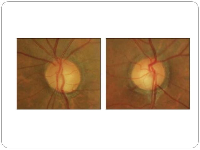 Normal tension glaucoma | PPTX