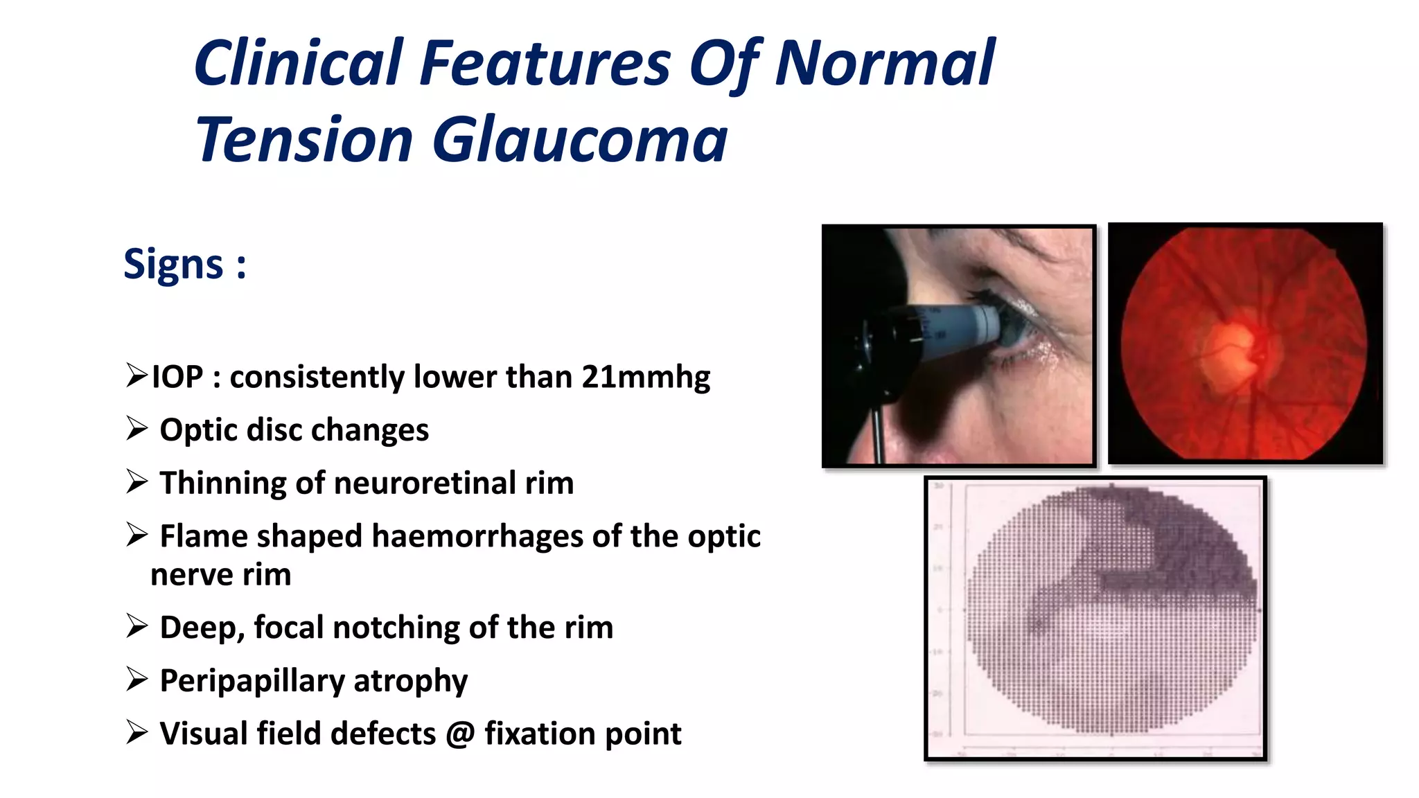 Normal Tension Glaucoma.pptx | Eye and Vision Conditions | Diseases and ...