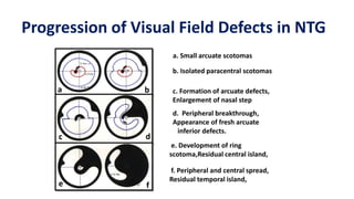 Normal Tension Glaucoma.pptx