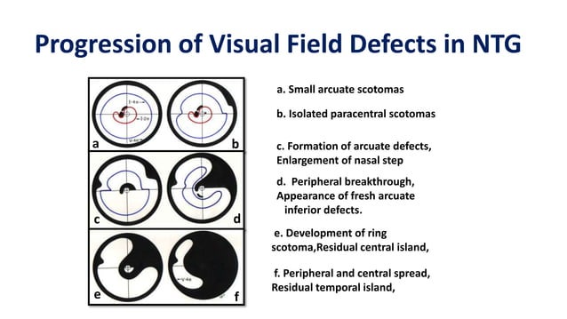 Normal Tension Glaucoma.pptx | Eye and Vision Conditions | Diseases and ...