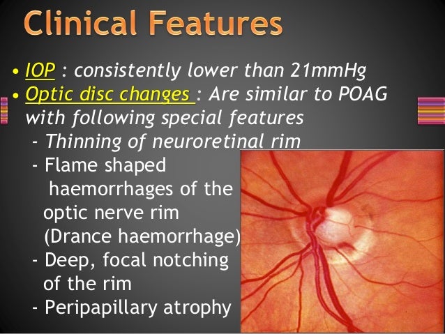 Normal tension glaucoma ntg