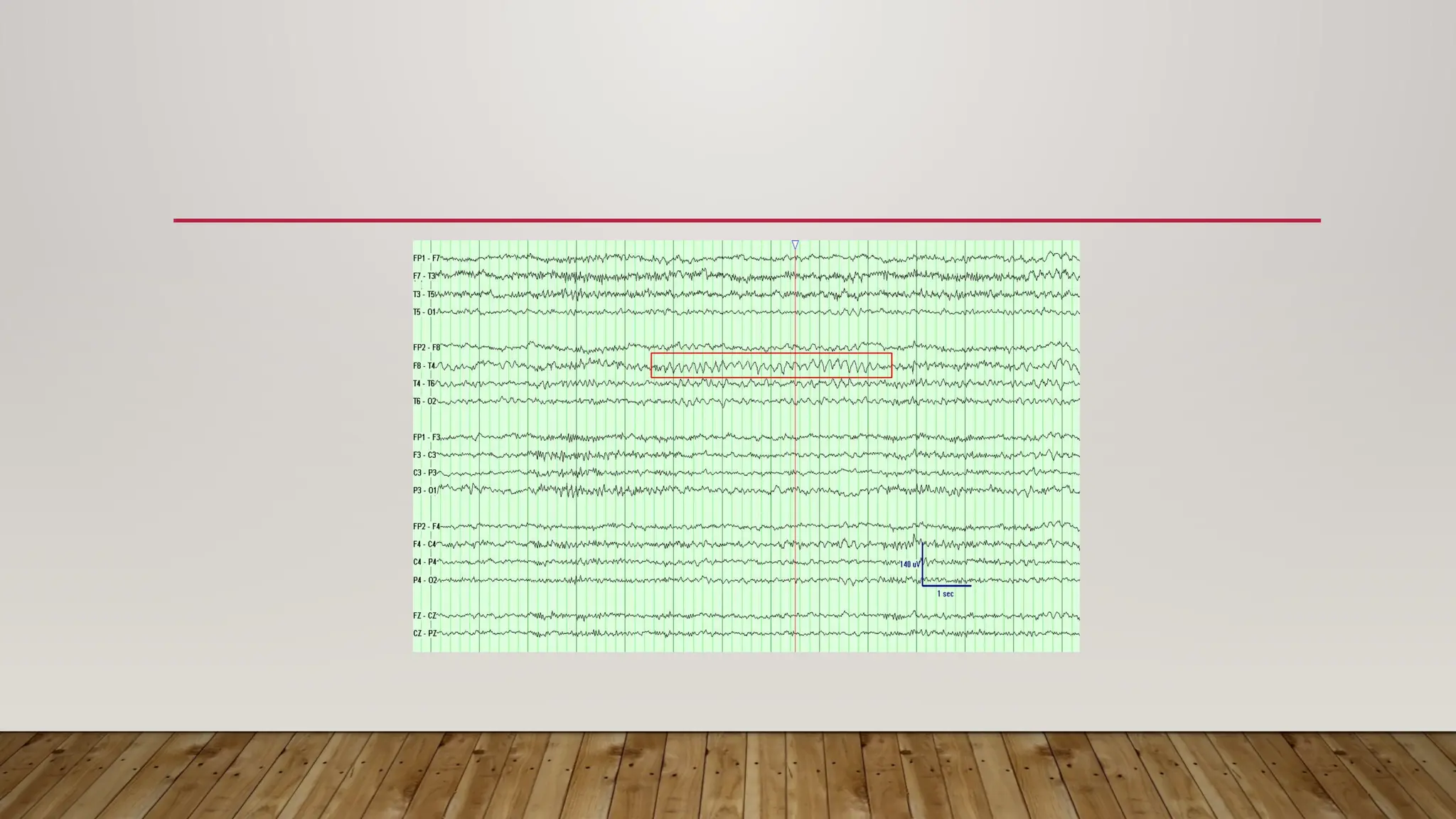 Normal variants.pptx for all EEG changes for ppl | PPTX