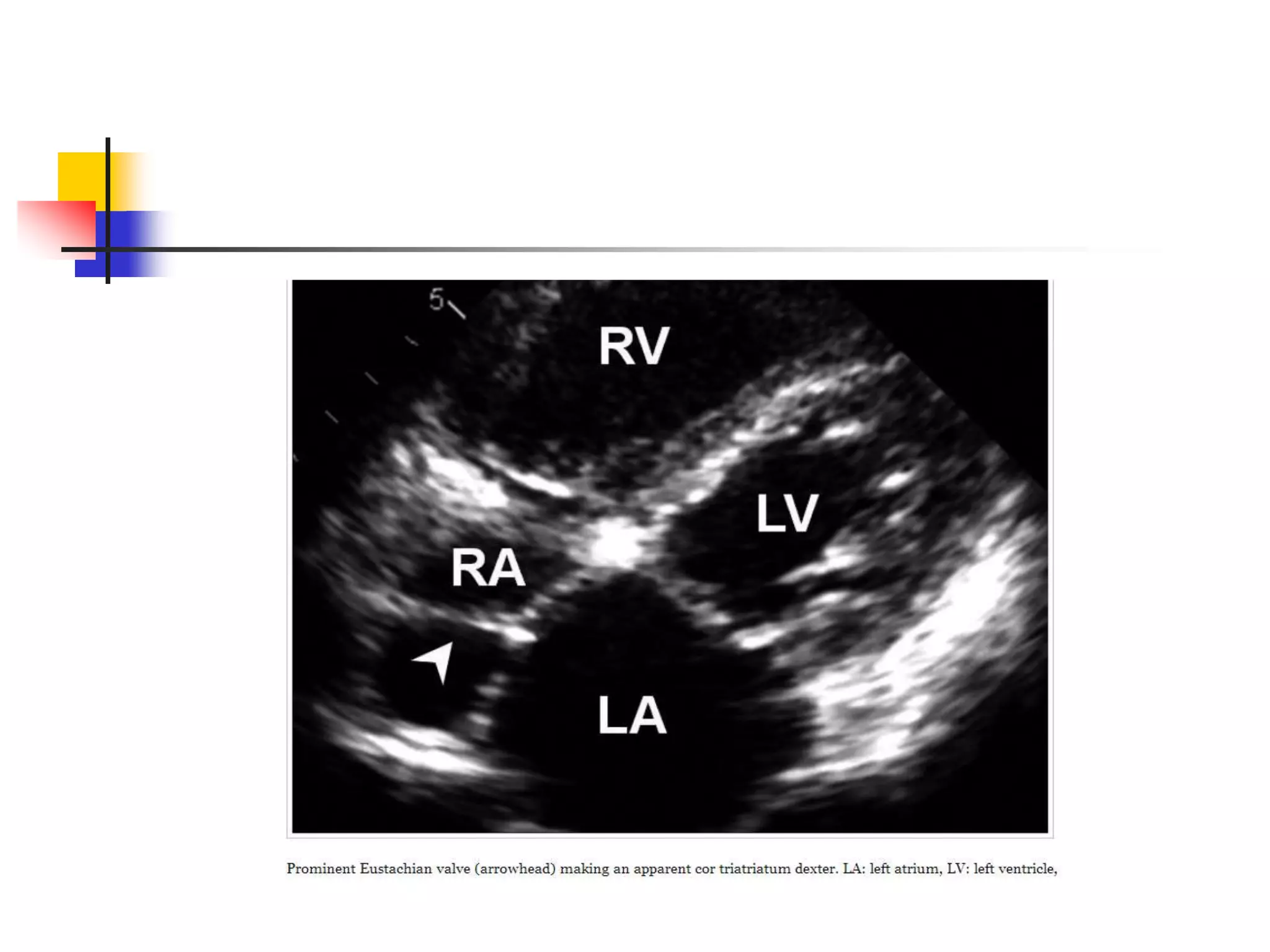 Normal variants of heart structures | PPTX