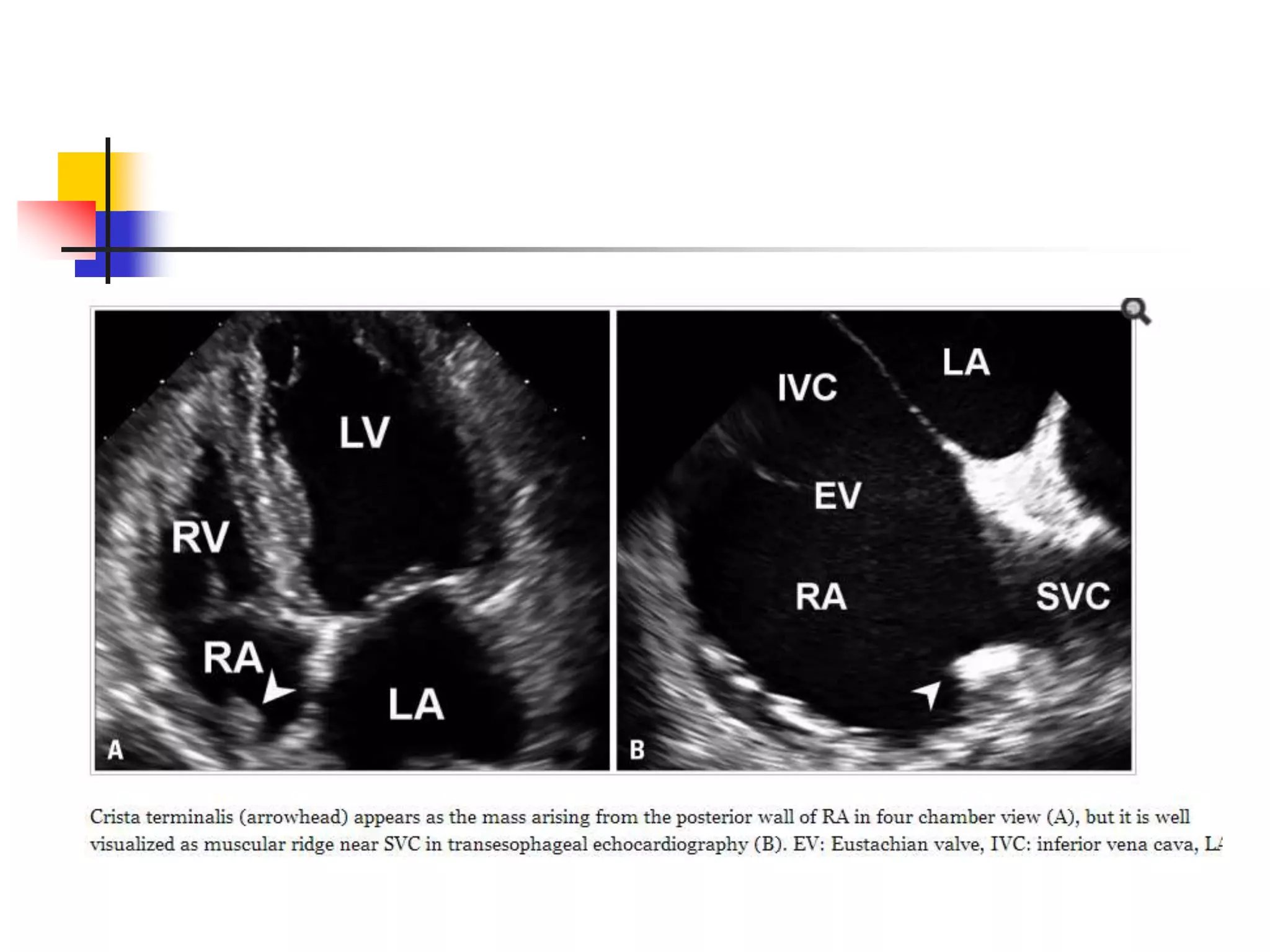Normal variants of heart structures | PPTX