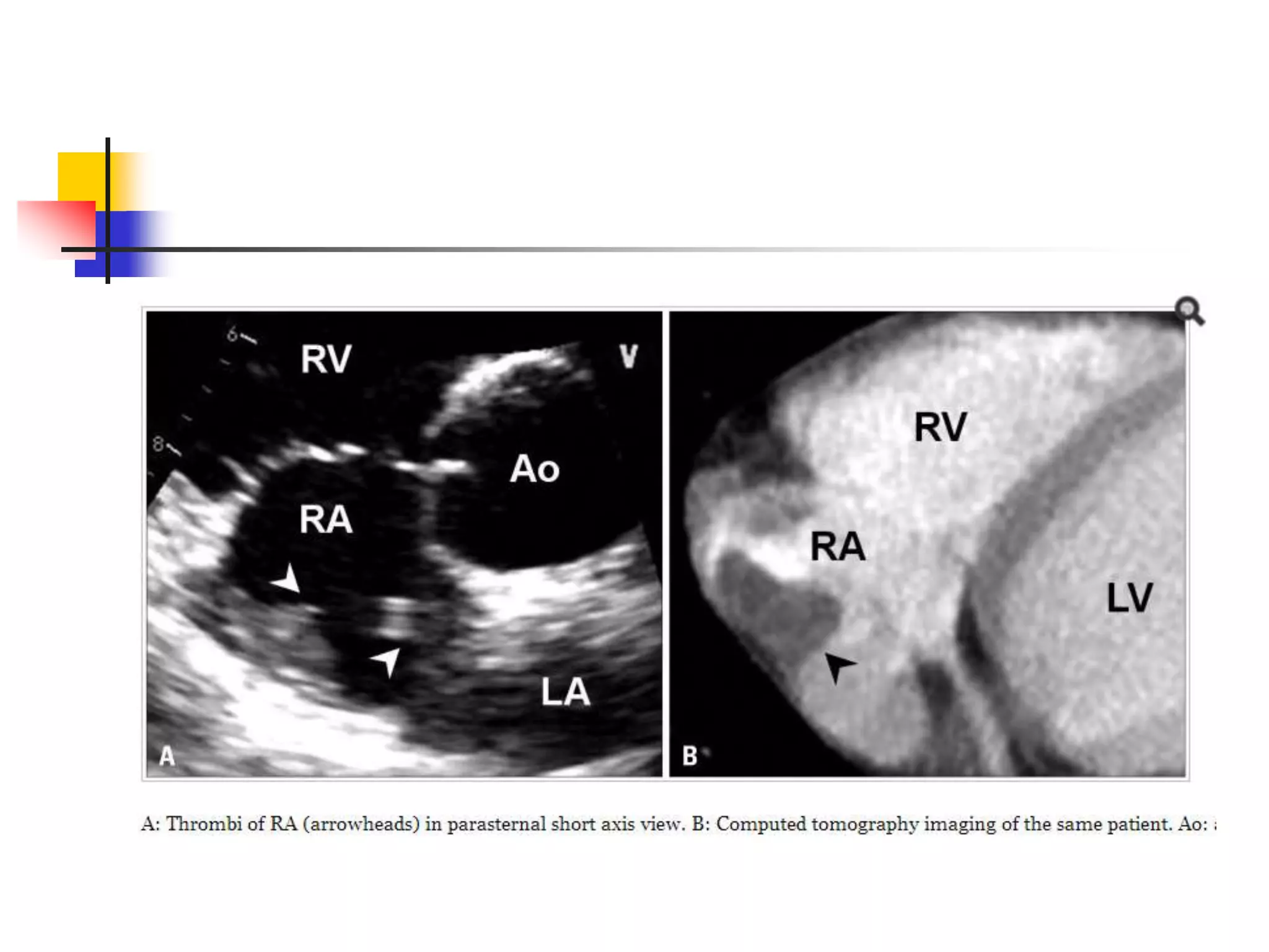 Normal variants of heart structures | PPTX | Heart and Cardiovascular ...