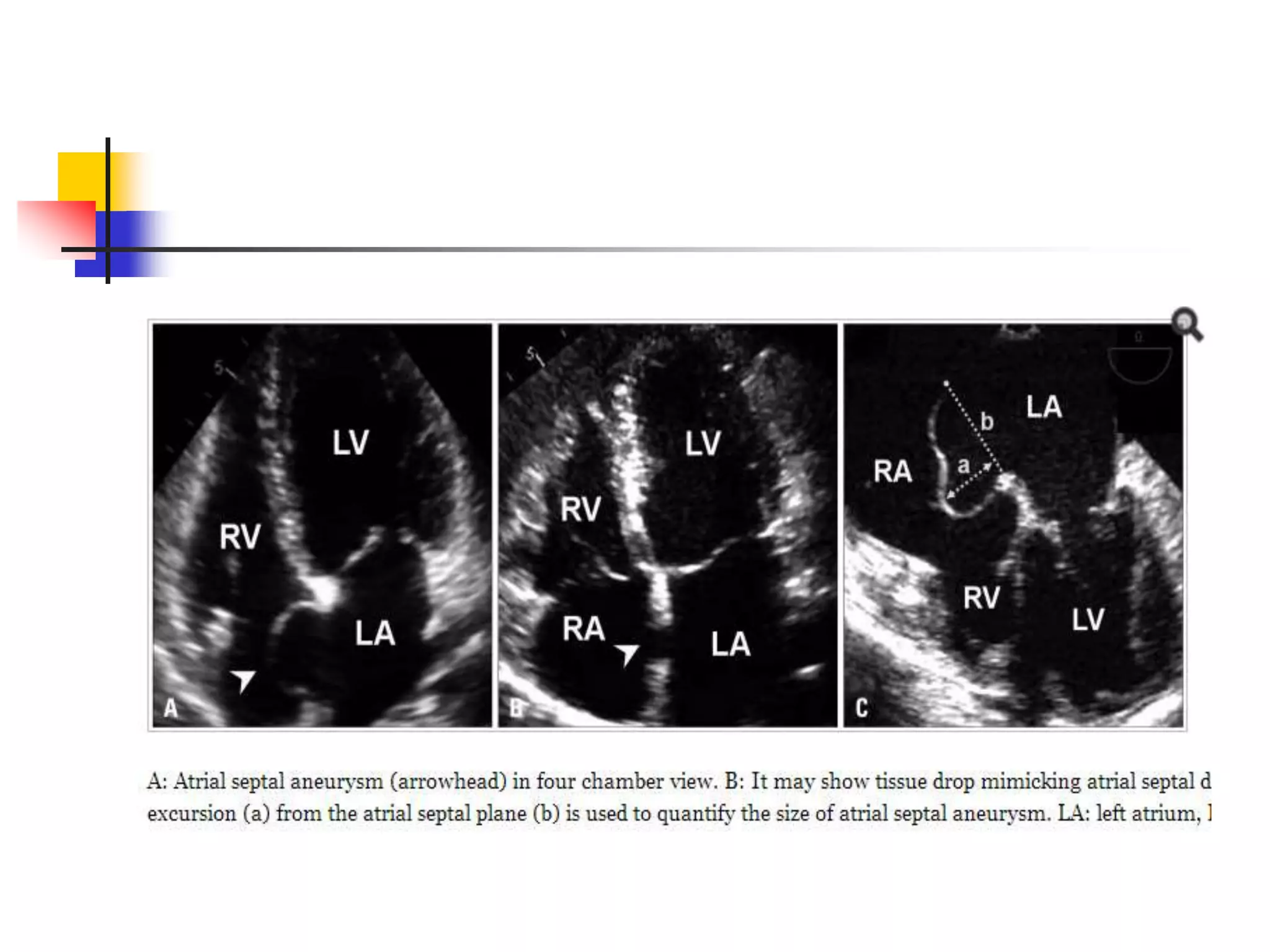 Normal variants of heart structures | PPTX