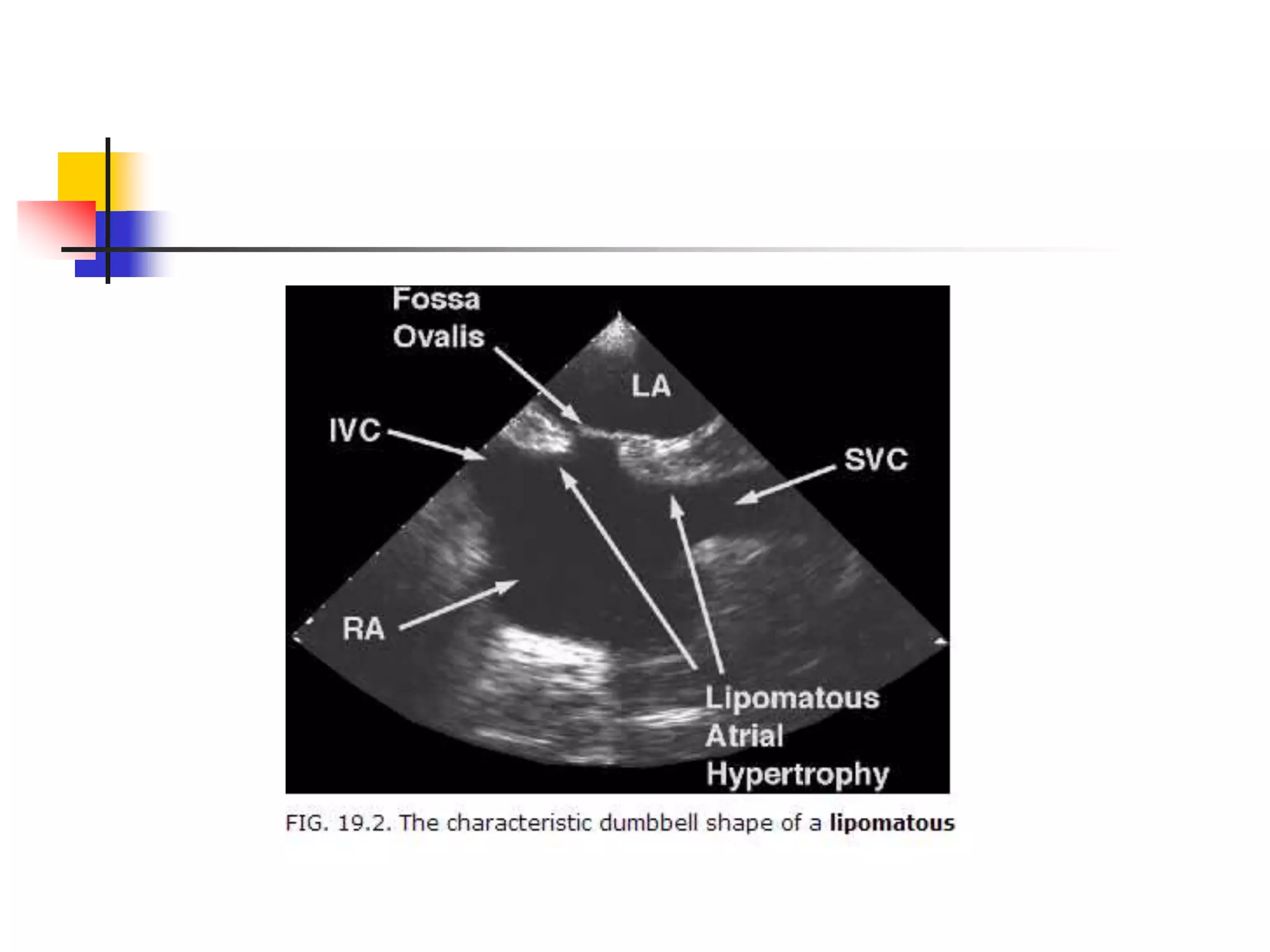 Normal variants of heart structures | PPTX | Heart and Cardiovascular ...