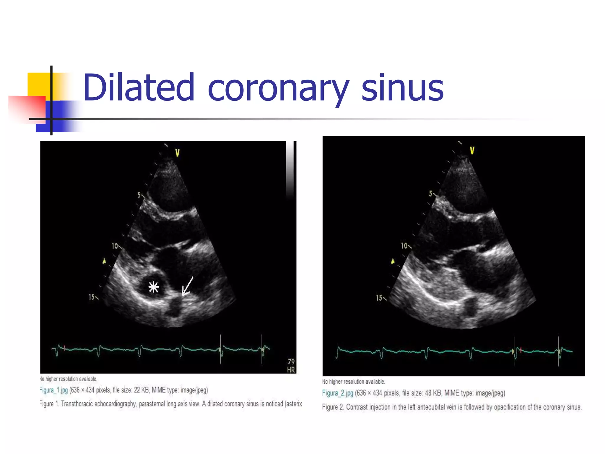 Normal variants of heart structures | PPTX | Heart and Cardiovascular ...