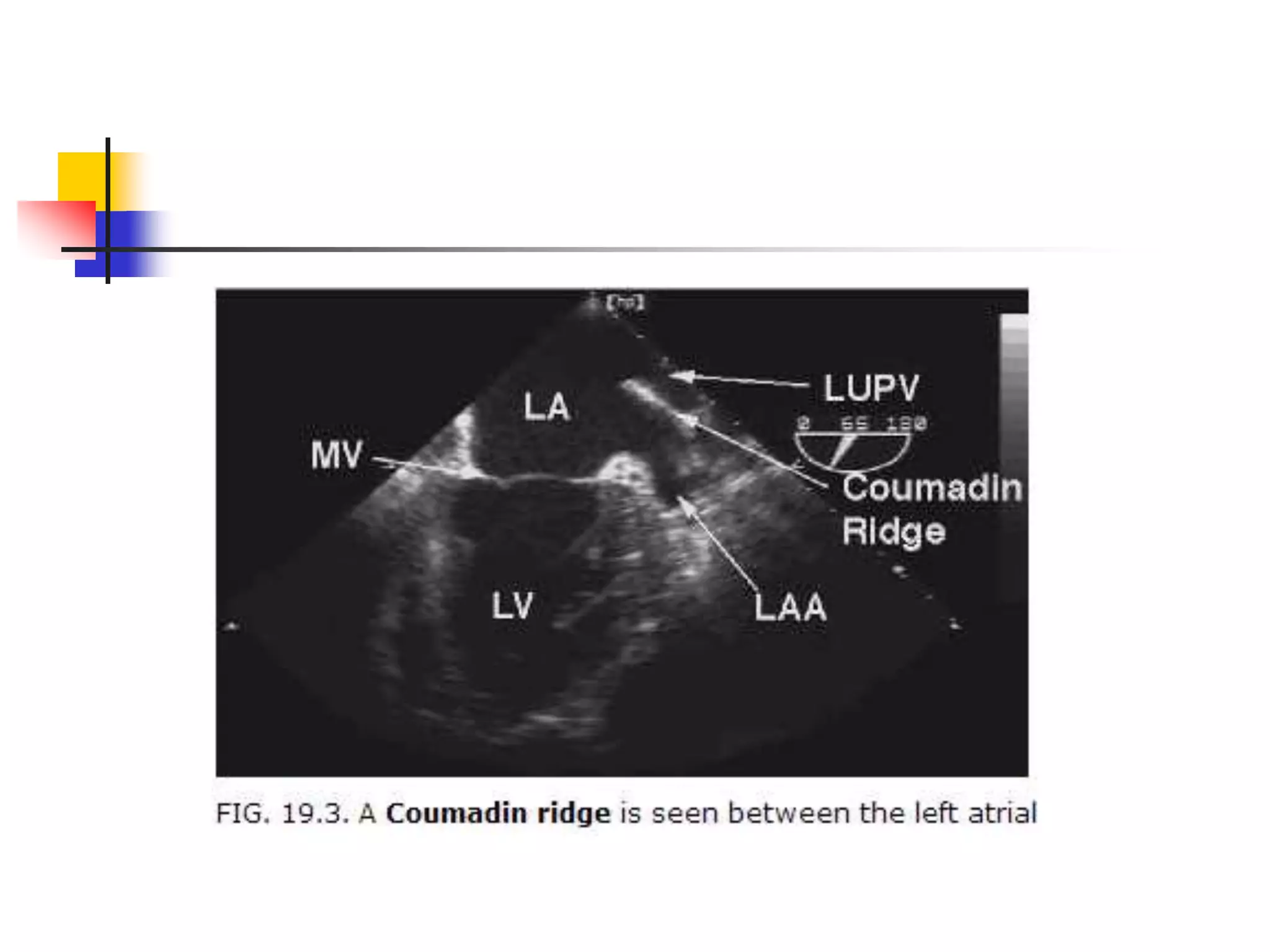Normal variants of heart structures | PPTX | Heart and Cardiovascular ...