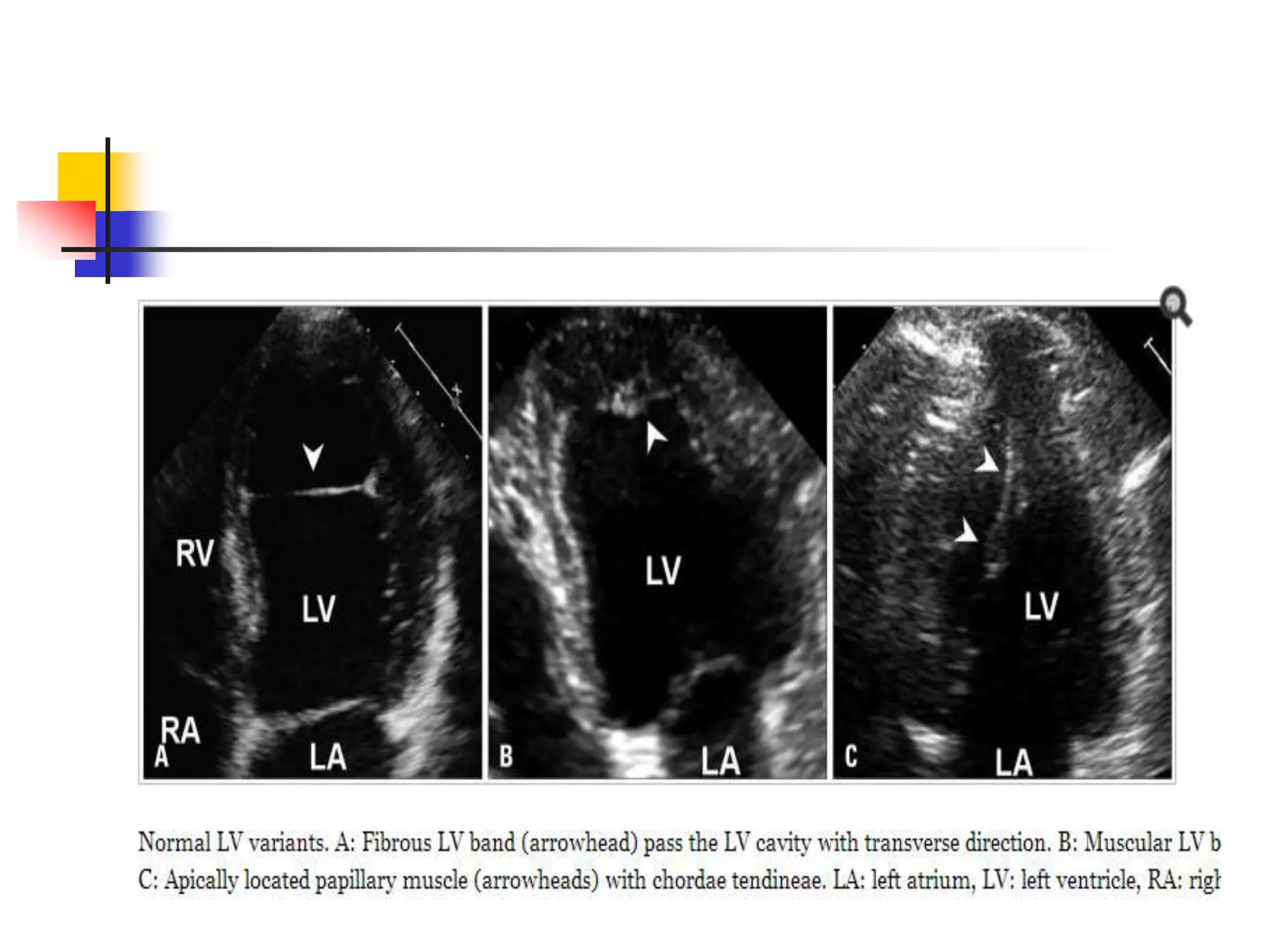 Normal variants of heart structures | PPTX
