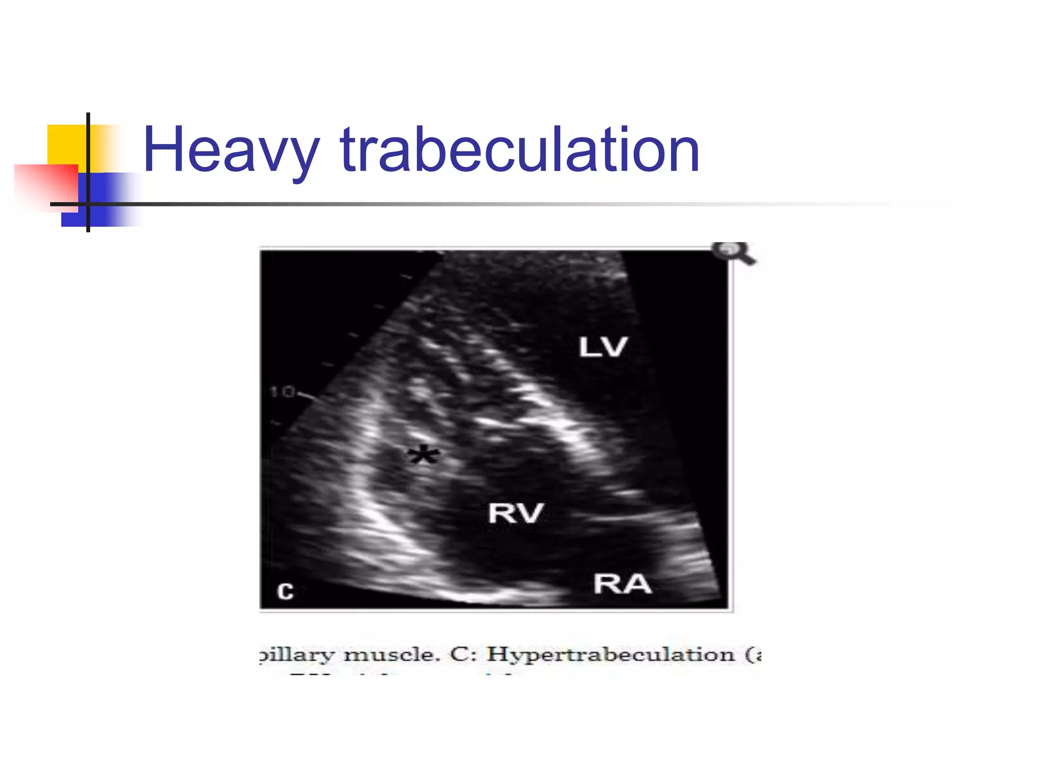 Normal variants of heart structures | PPTX