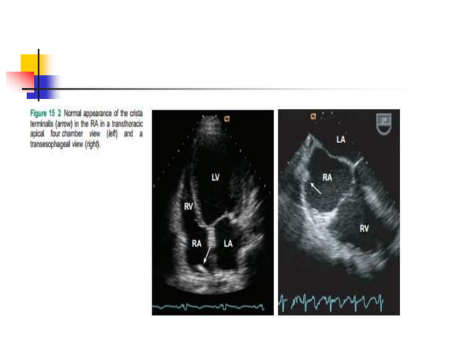 Normal variants of heart structures | PPTX | Heart and Cardiovascular ...