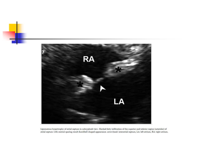 Normal variants of heart structures | PPTX | Heart and Cardiovascular ...