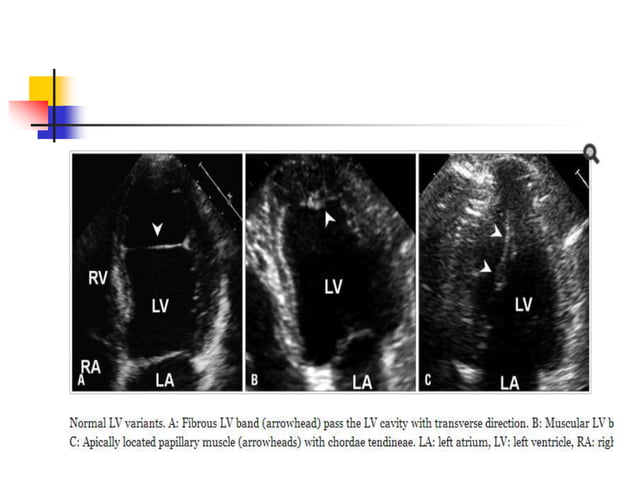 Normal variants of heart structures | PPTX | Heart and Cardiovascular ...
