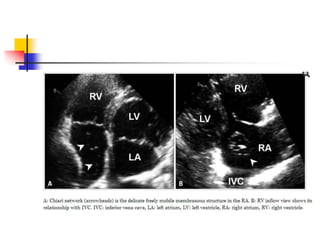 Chiari Network Vs Eustachian Valve
