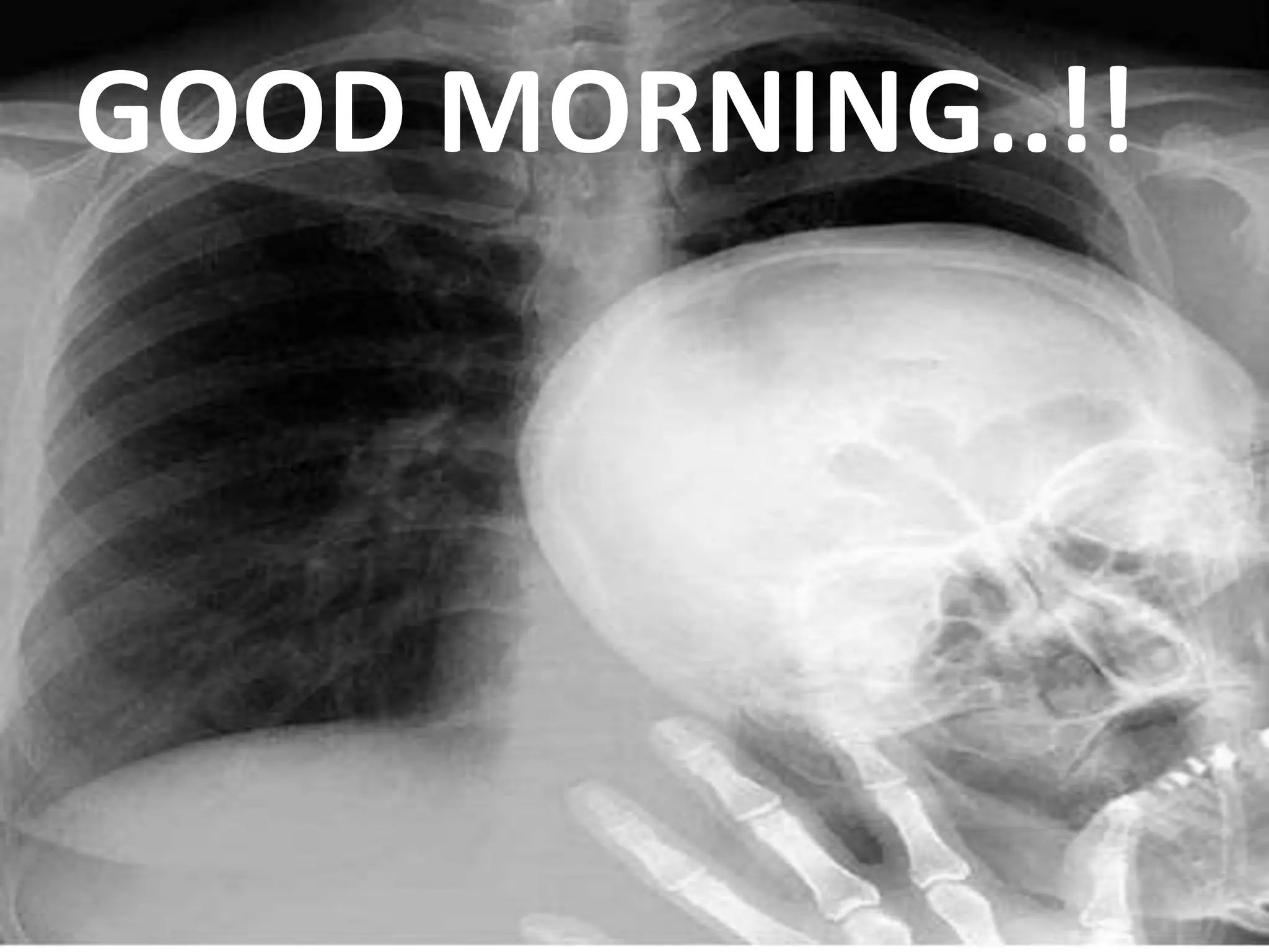 Normal chest x ray | PPTX