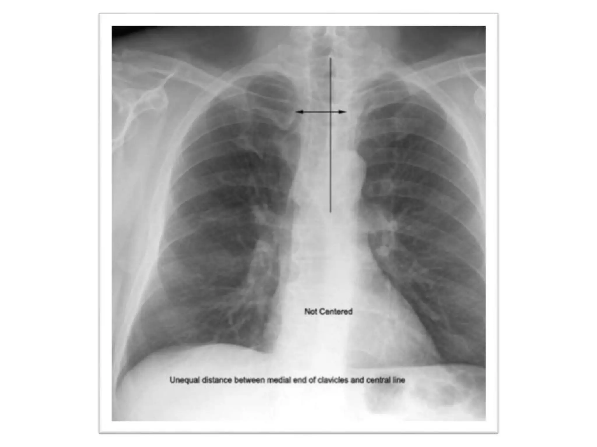 Normal chest x ray | PPT