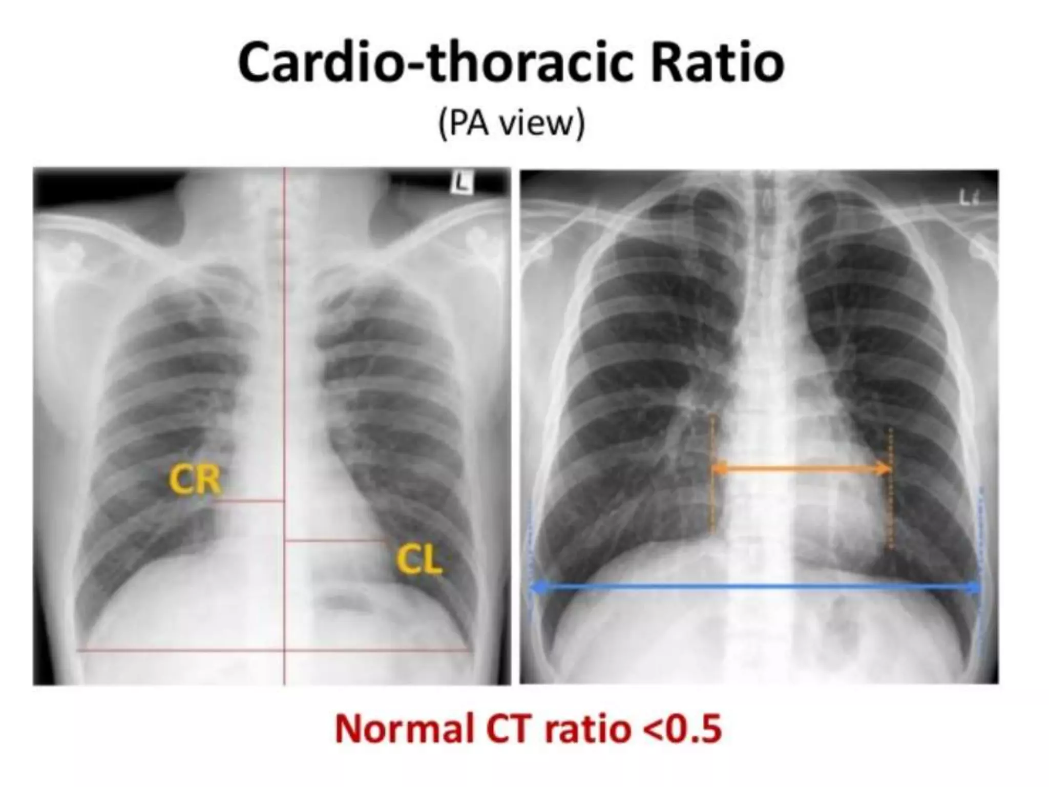 Normal chest x ray | PPTX
