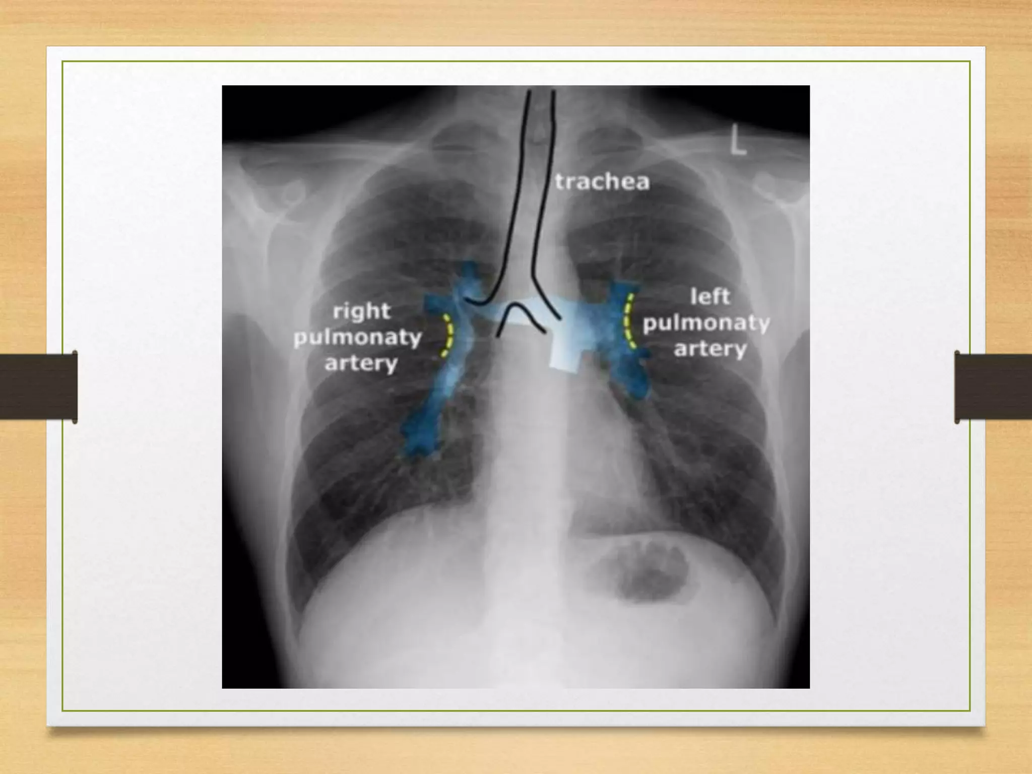 Normal chest x ray | PPT