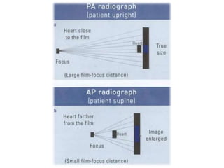 Normal chest x ray | PPTX