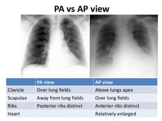 Normal chest x ray | PPTX