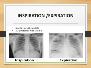 Normal chest x ray | PPT