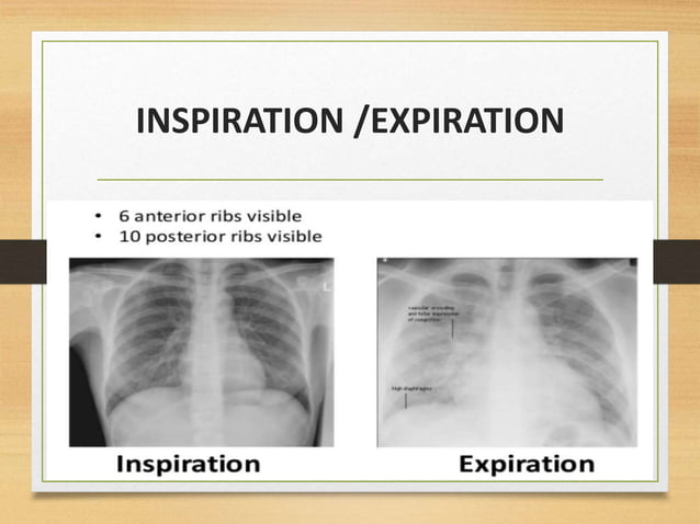 Normal chest x ray | PPT