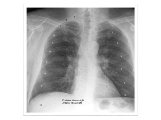 Normal chest x ray | PPT