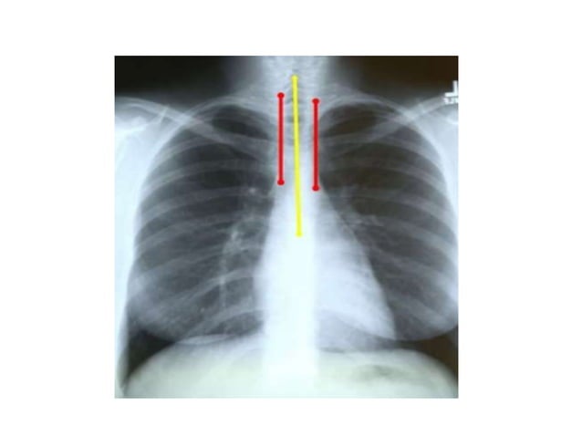 Normal chest x ray | PPT