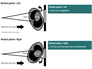 Normal chest x ray | PPT