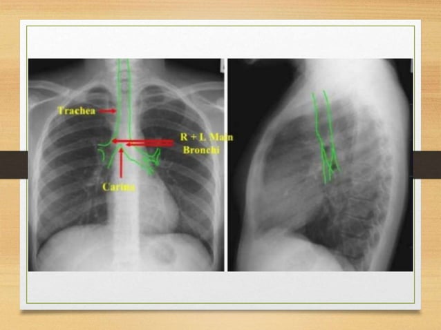 Normal chest x ray | PPT