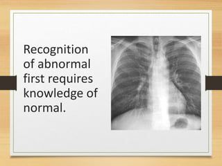 Normal chest x ray | PPT