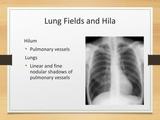 Normal chest x ray | PPTX