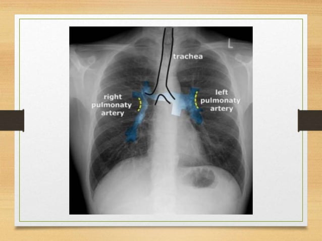 Normal chest x ray | PPT