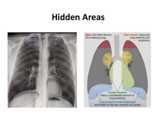 Normal chest x ray | PPTX