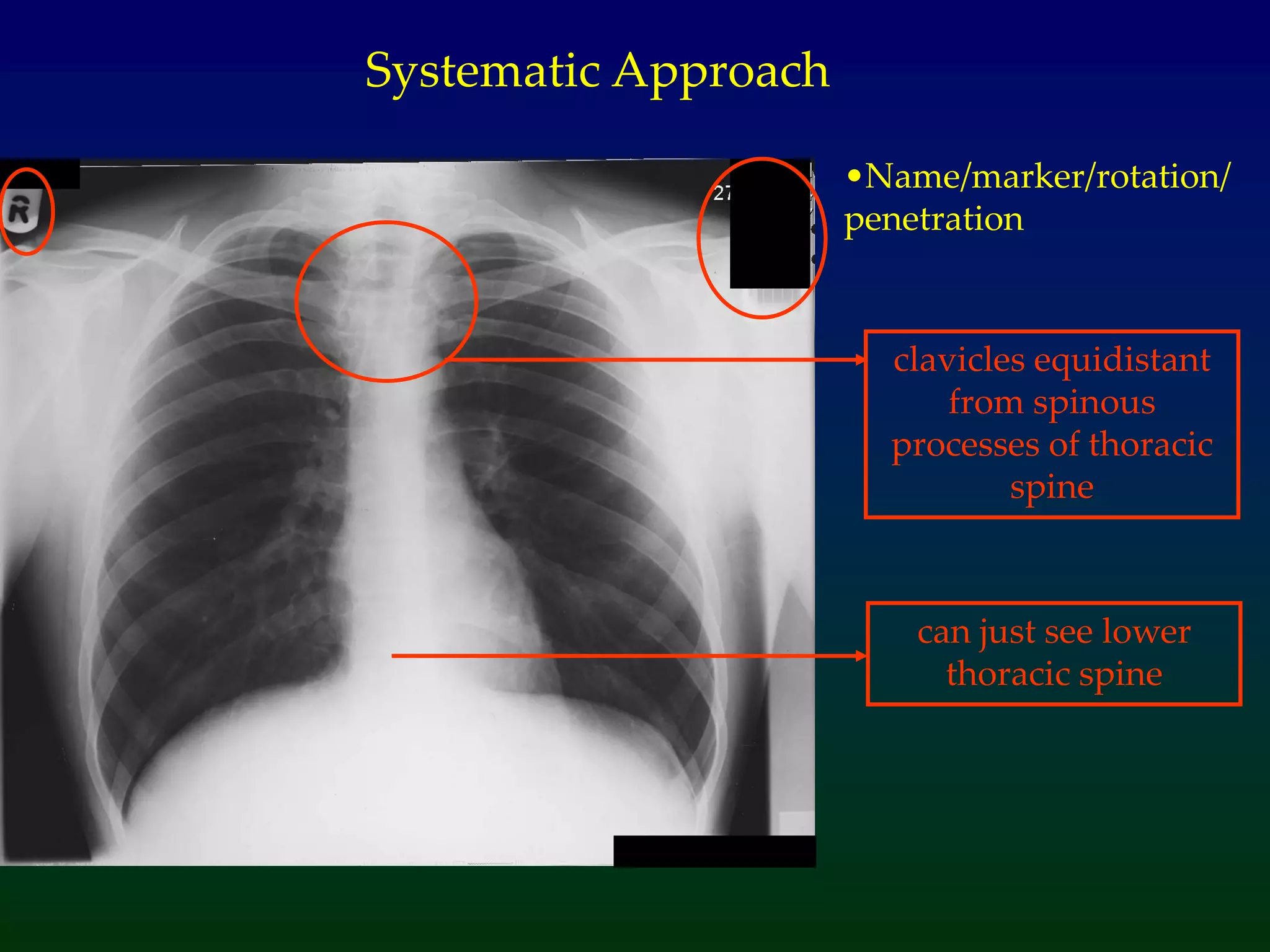 normalxray.ppt