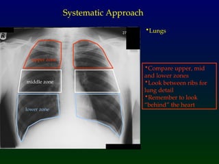 normal Chest x-ray radiological landmarks.ppt