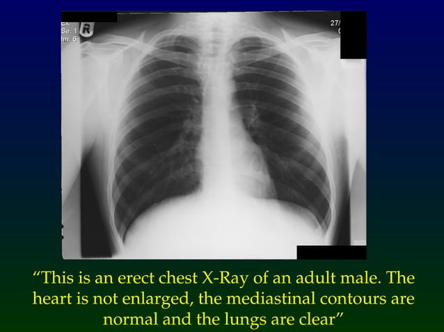 normal Chest x-ray radiological landmarks.ppt