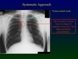 normal Chest x-ray radiological landmarks.ppt