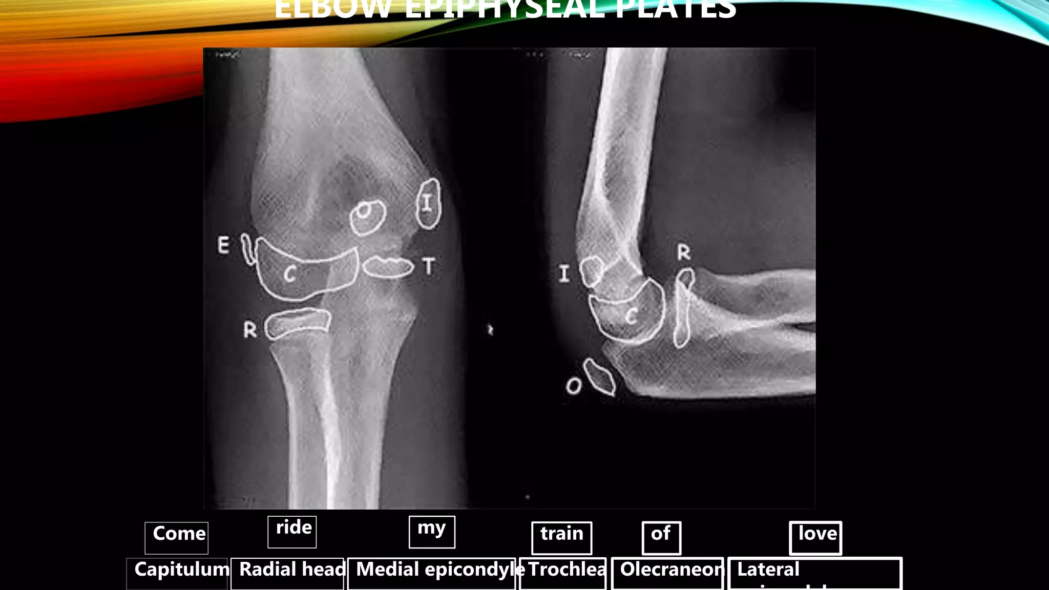 Normal X ray of long bones.pptx