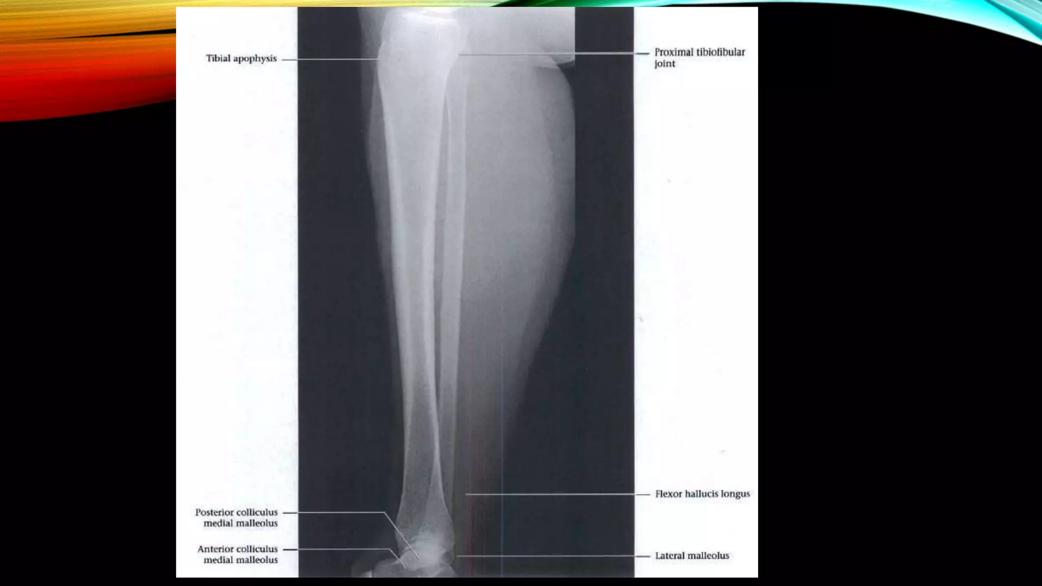 Normal X ray of long bones.pptx