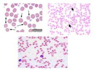 Normochromic normocytic anaemia | PPTX