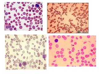 Normochromic normocytic anaemia | PPTX