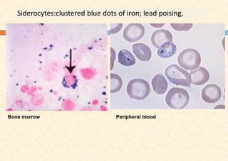 Normocytic Anemias.pdf | Blood Disorders | Diseases and Conditions