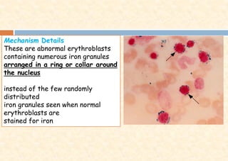Normocytic Anemias.pdf | Blood Disorders | Diseases and Conditions