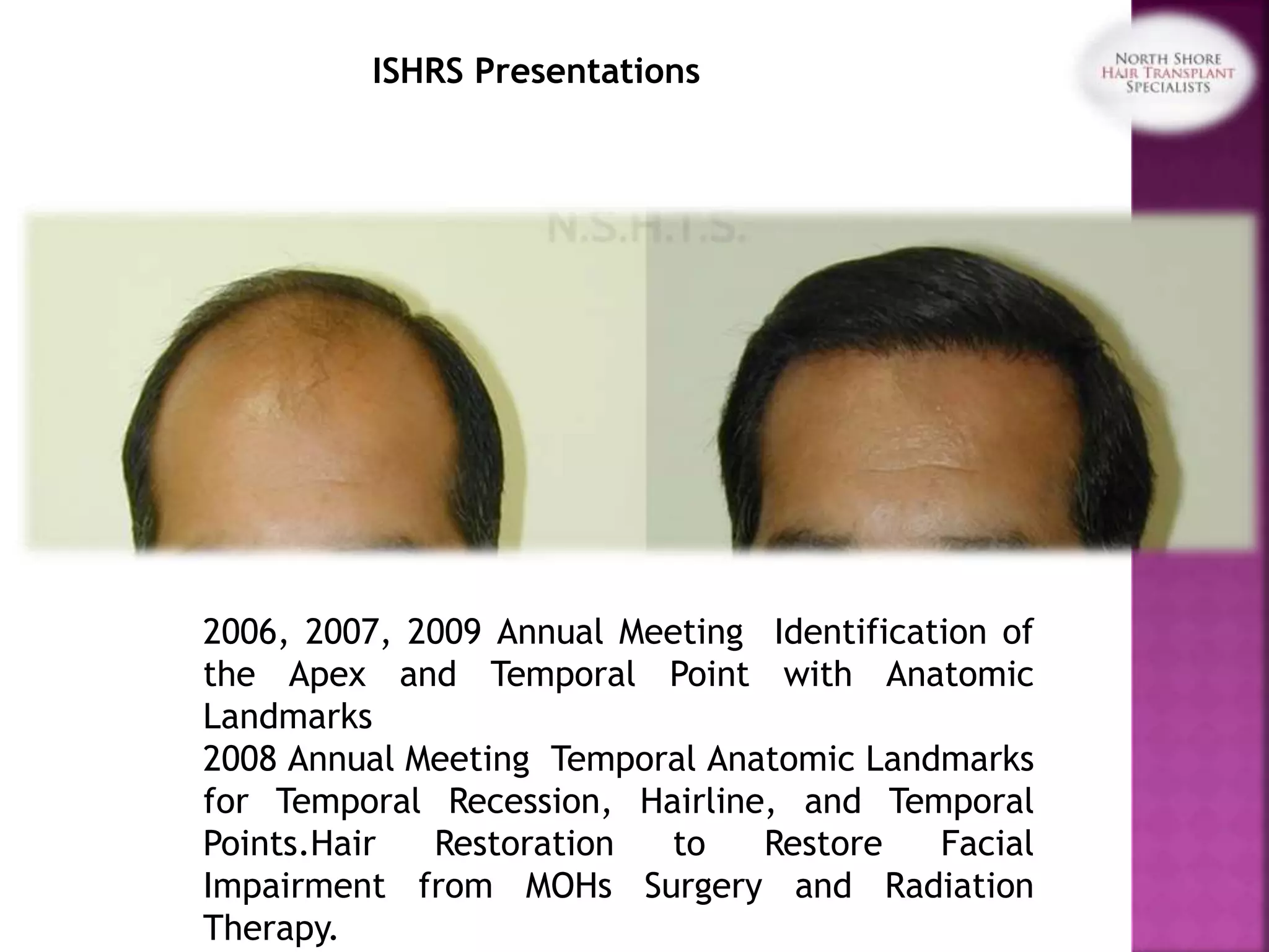 North shore hair transplant specialists | PPTX